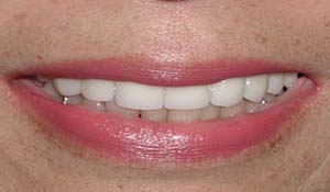 Dentist in Oakland, CA - Smile Gallery Curtis J. Perry DDS | Before & After