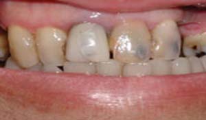 Dentist in Oakland, CA - Smile Gallery Curtis J. Perry DDS | Before & After