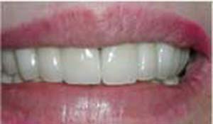 Dentist in Oakland, CA - Smile Gallery Curtis J. Perry DDS | Before & After