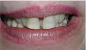 Dentist in Oakland, CA - Smile Gallery Curtis J. Perry DDS | Before & After